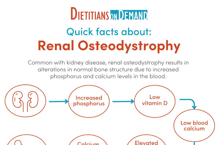 Quick Facts About Renal Osteodystrophy | Infographic – Dietitians On Demand
